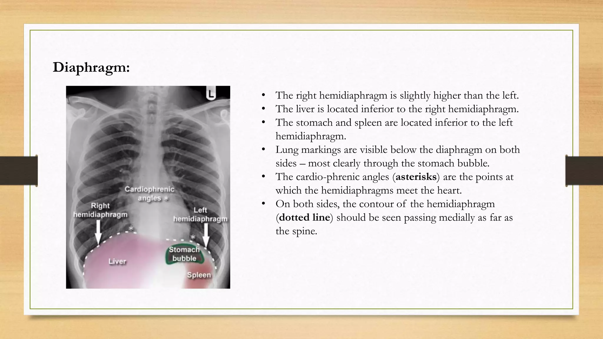 Normal chest x ray | PPTX