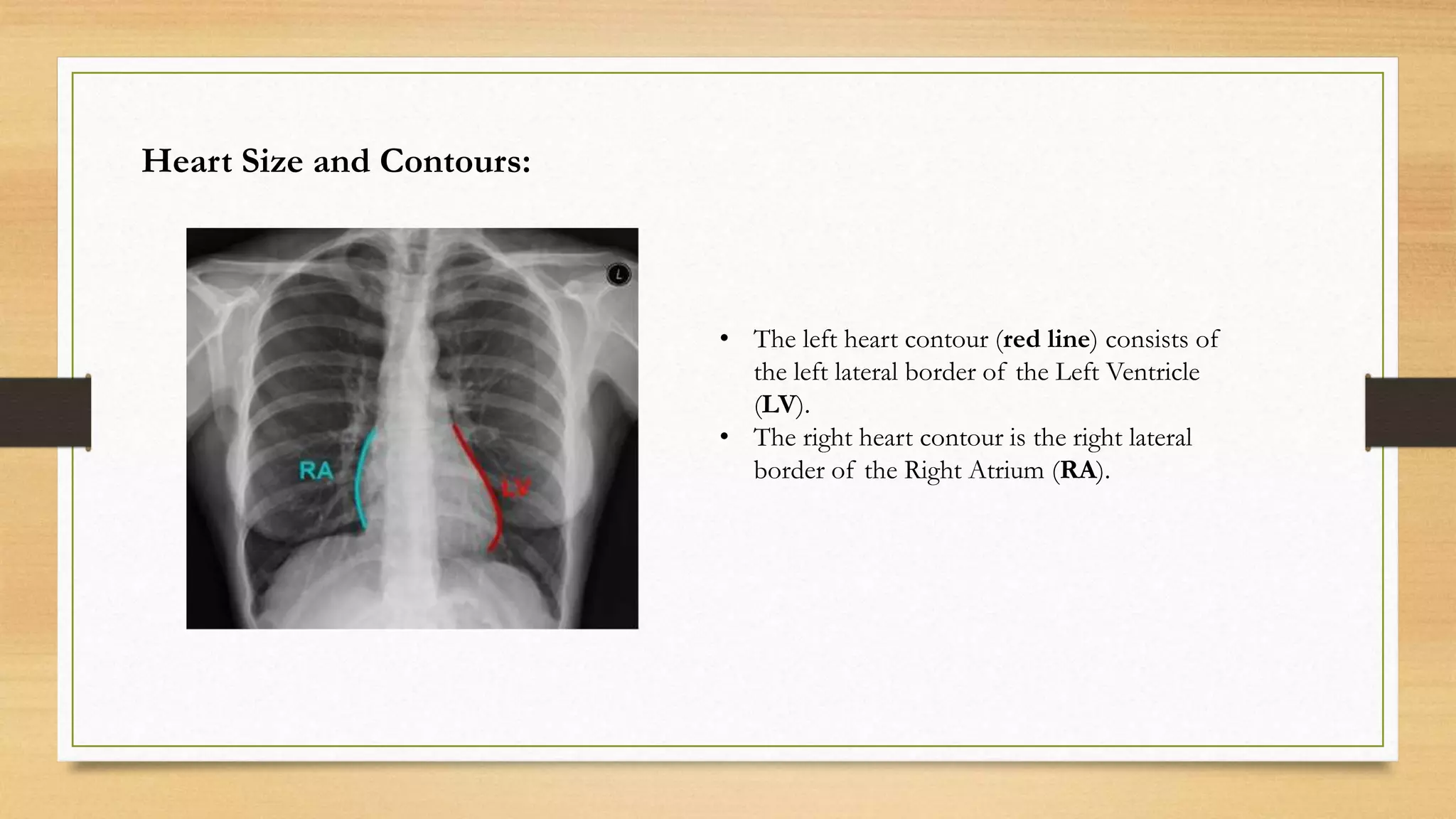 Normal chest x ray | PPTX