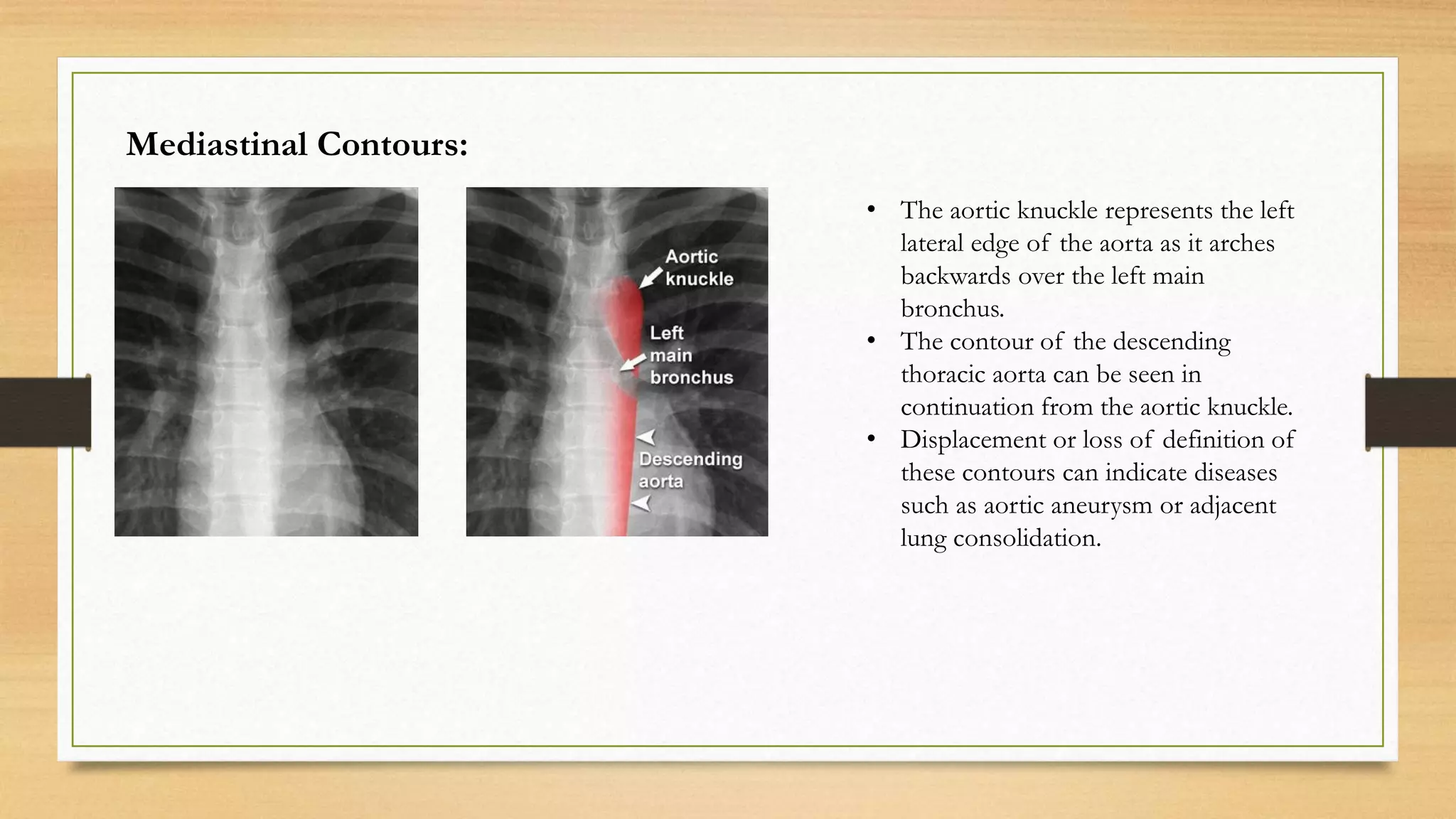 Normal chest x ray | PPTX