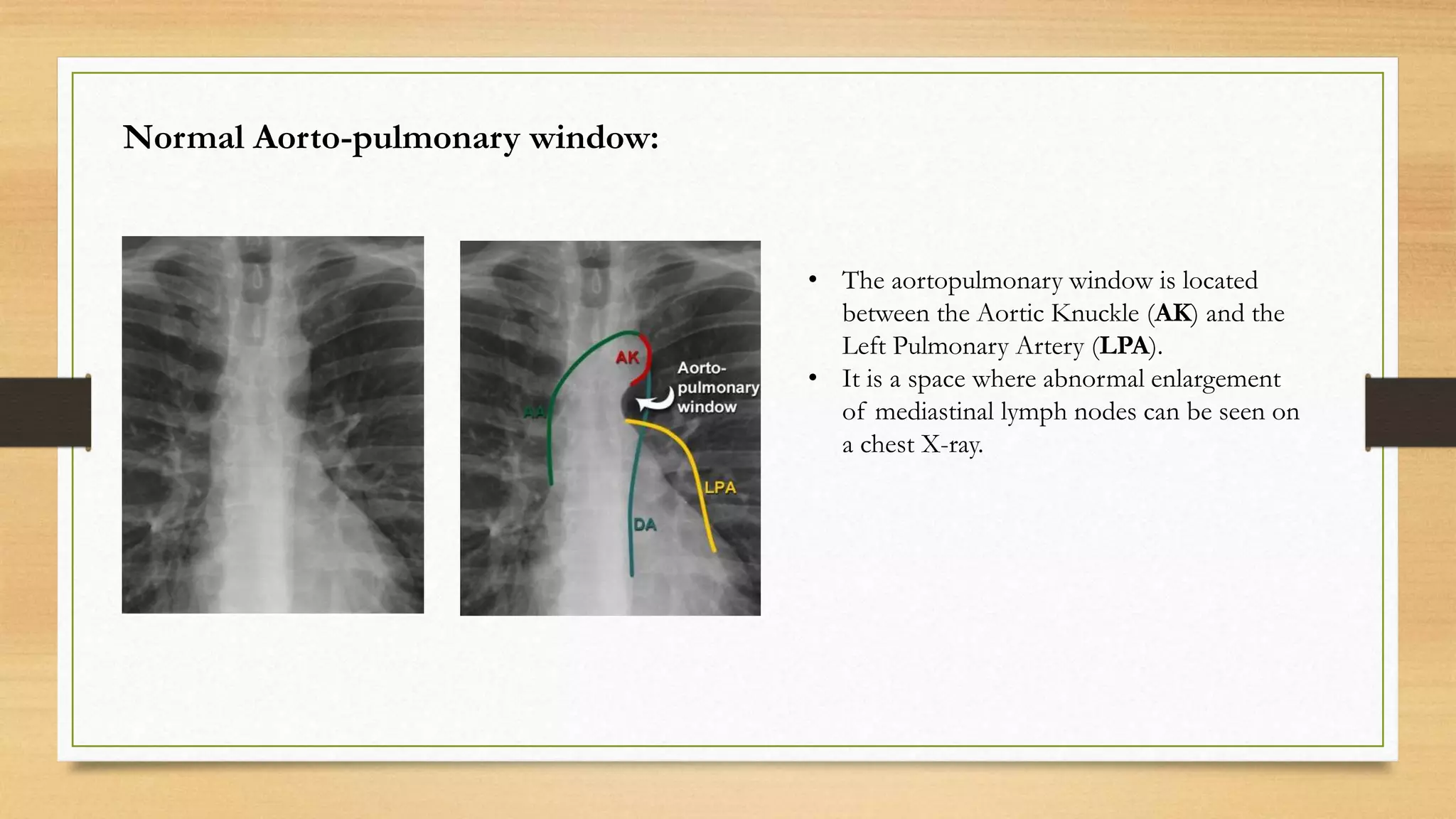 Normal chest x ray | PPTX