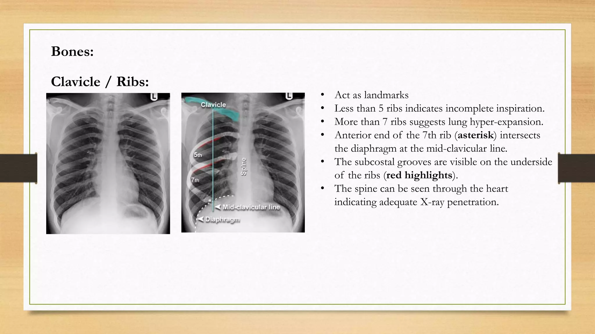 Normal chest x ray | PPTX
