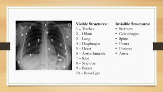 Normal chest x ray | PPTX