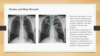 Normal chest x ray | PPTX