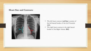 Normal chest x ray | PPTX