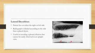Normal chest x ray | PPTX