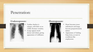 Normal chest x ray | PPTX