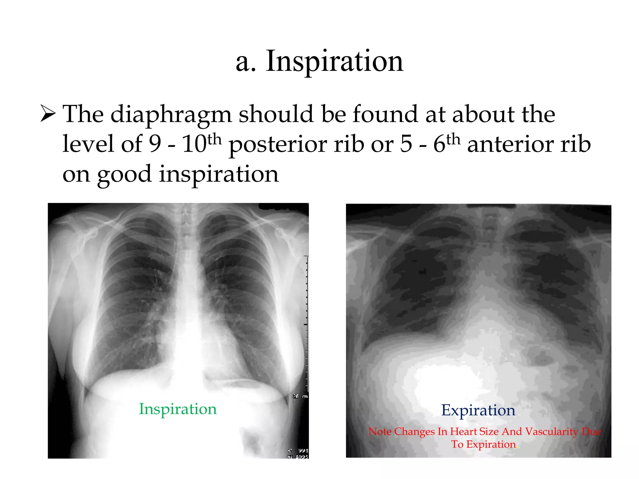 Normal Chest X-Rays & Its Systemic Approach- Anatomy | PPTX