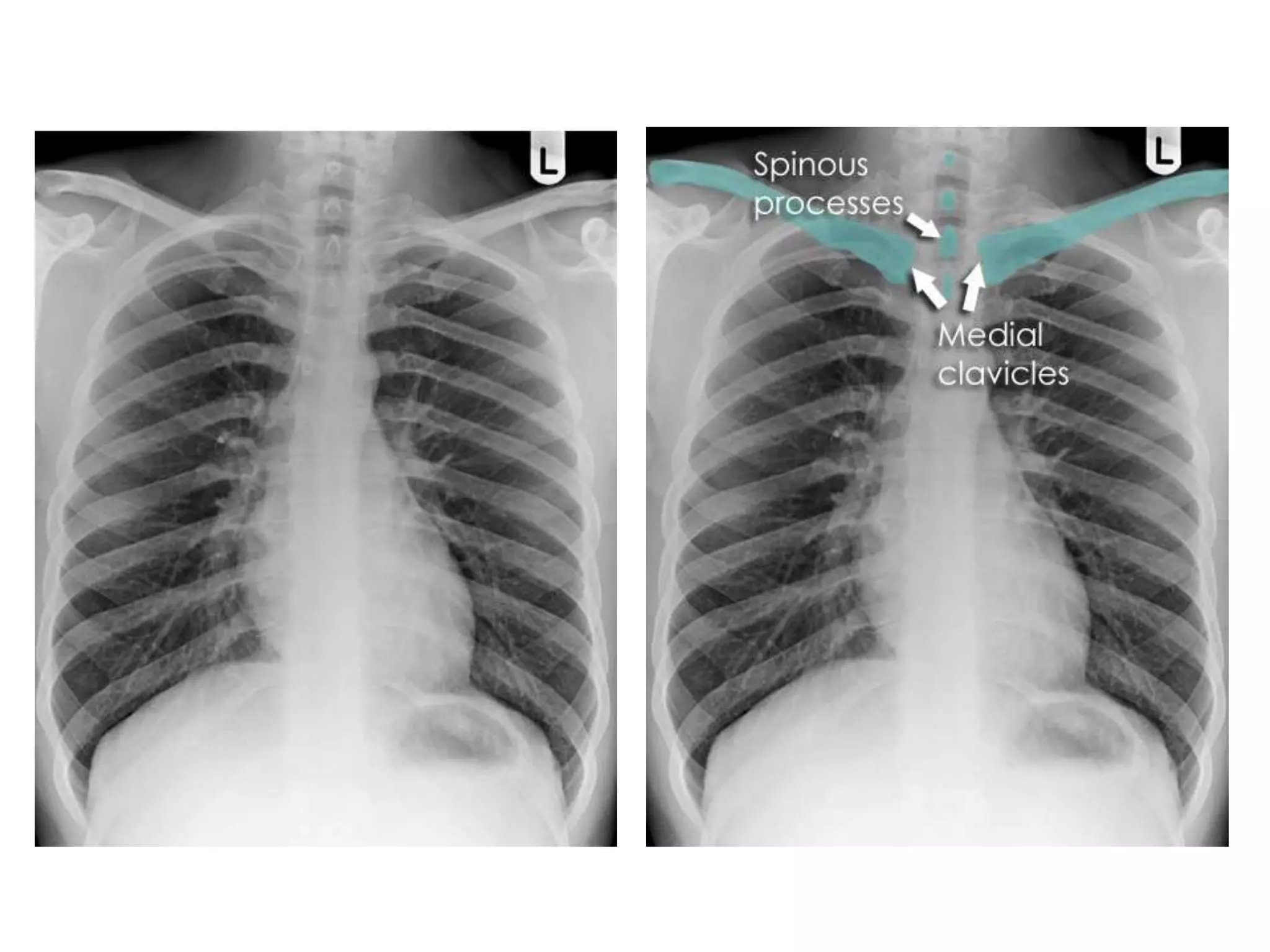 Normal Chest X-Rays & Its Systemic Approach- Anatomy | PPTX