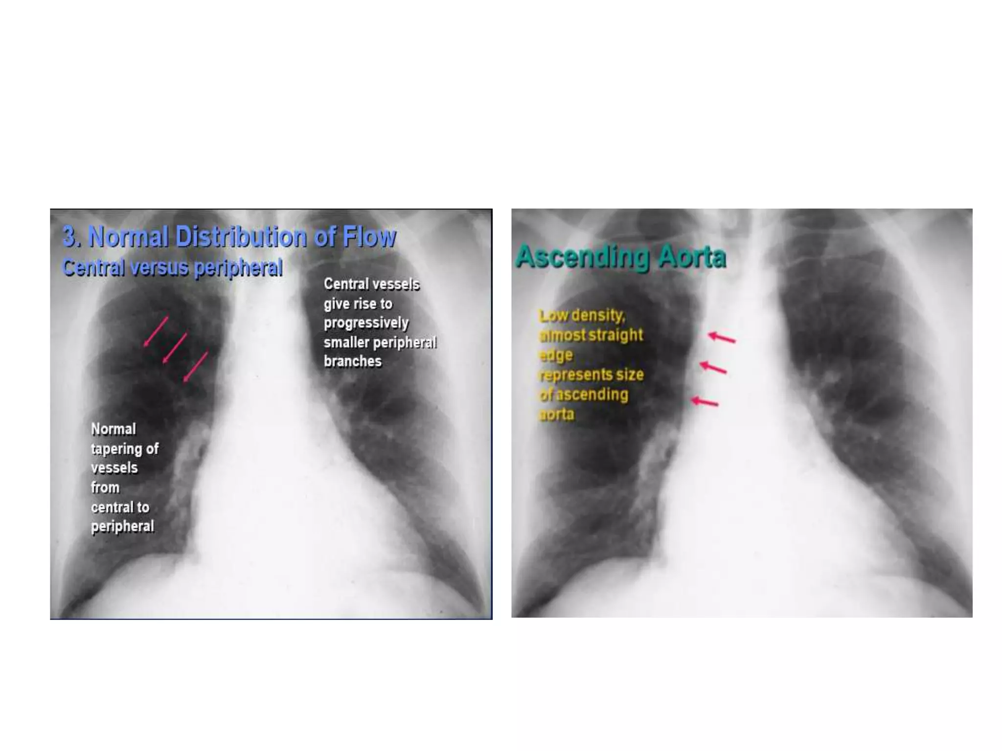 Normal Chest X-Rays & Its Systemic Approach- Anatomy | PPTX