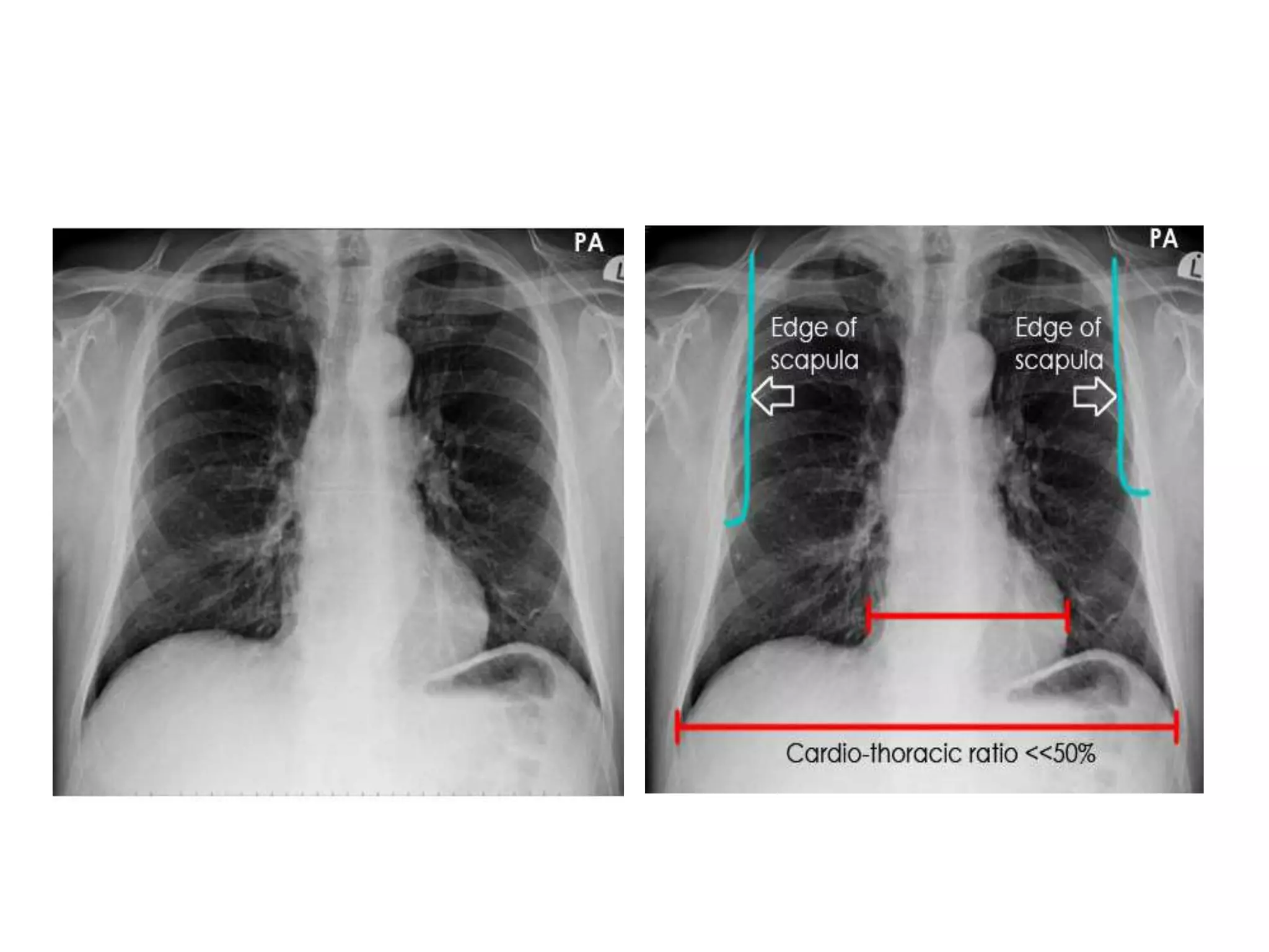 Normal Chest X-Rays & Its Systemic Approach- Anatomy | PPTX