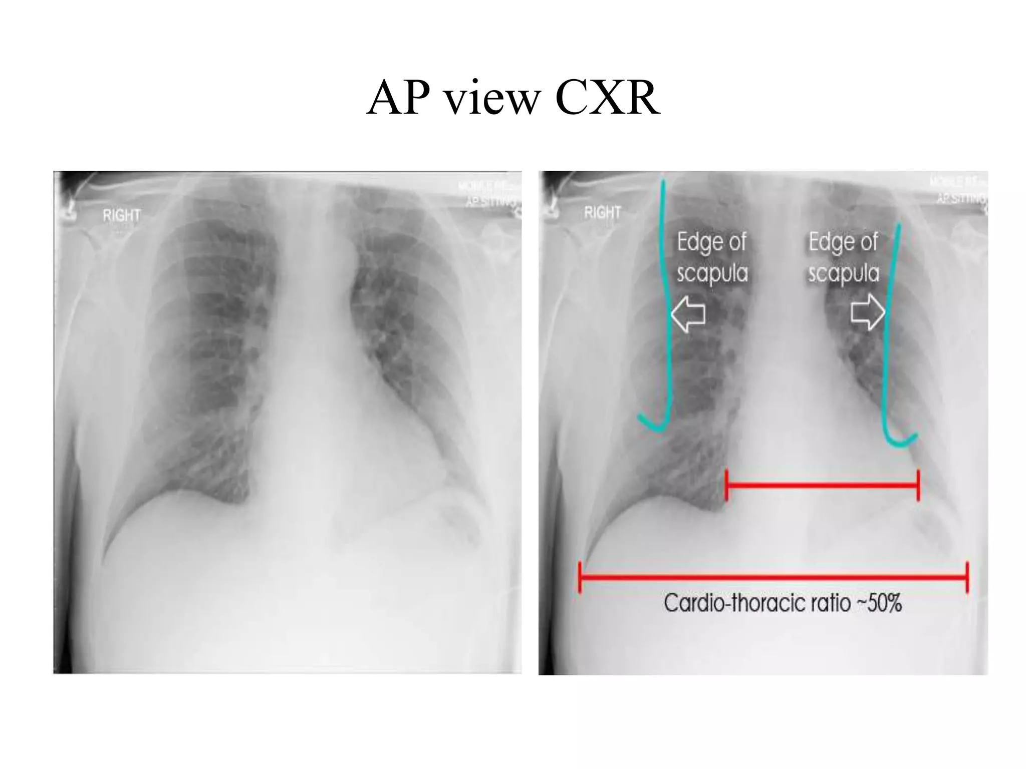 Normal Chest X-Rays & Its Systemic Approach- Anatomy | PPTX