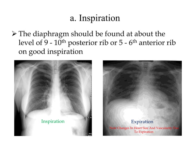 Normal Chest X-Rays & Its Systemic Approach- Anatomy | PPTX