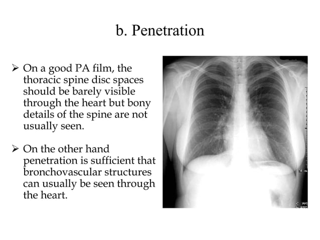 Normal Chest X-Rays & Its Systemic Approach- Anatomy | PPTX