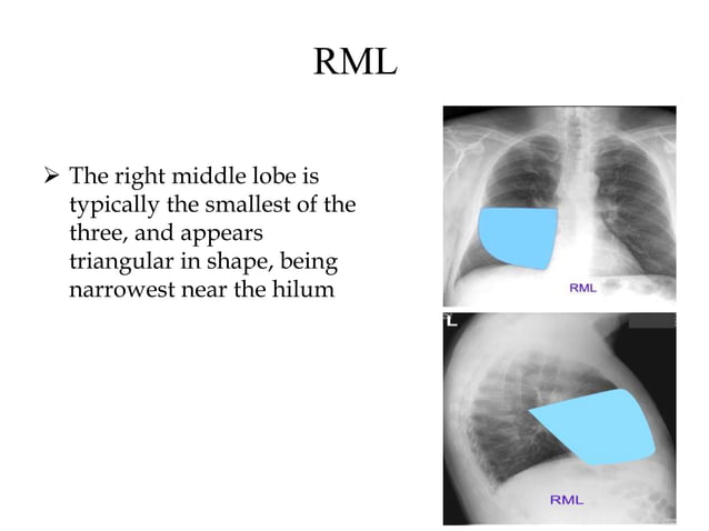 Normal Chest X-Rays & Its Systemic Approach- Anatomy | PPTX