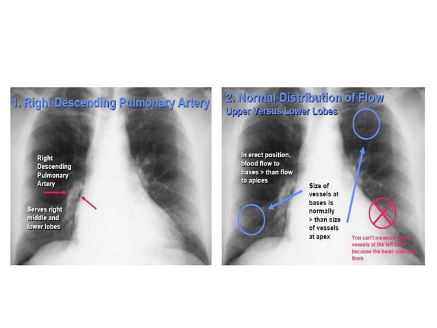 Normal Chest X-Rays & Its Systemic Approach- Anatomy | PPTX