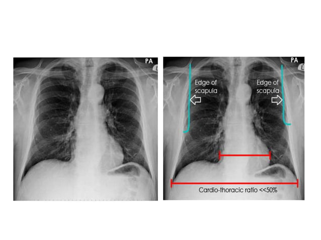 Normal Chest X-Rays & Its Systemic Approach- Anatomy | PPTX