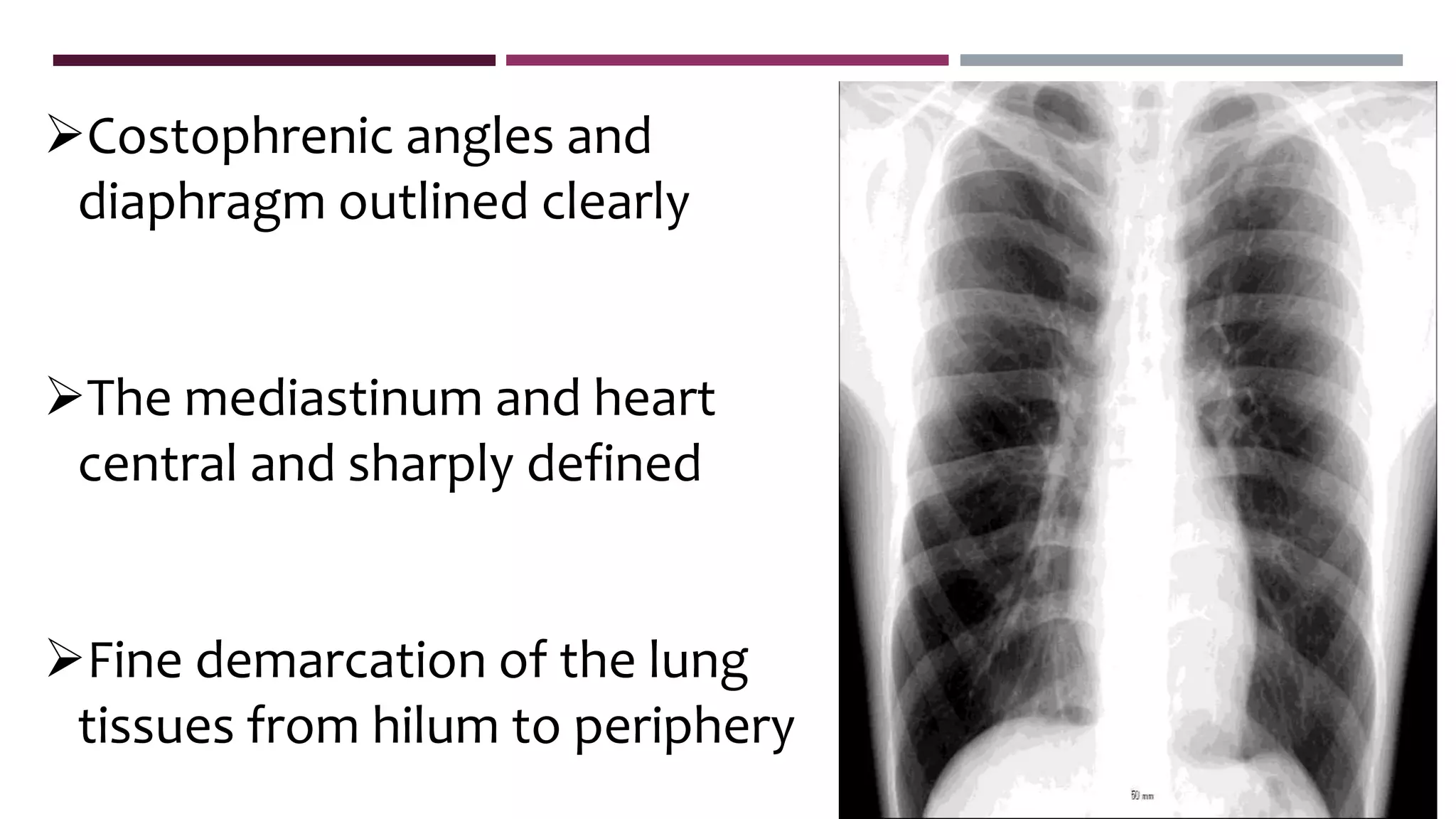 Normal chest xray | PPT