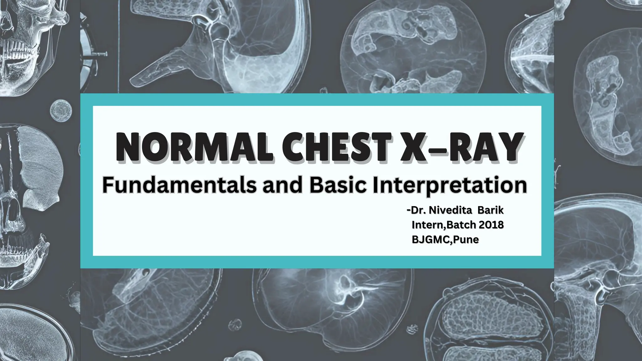 Normal chest Xray: Fundamentals and Basic Interpretation (By Dr ...