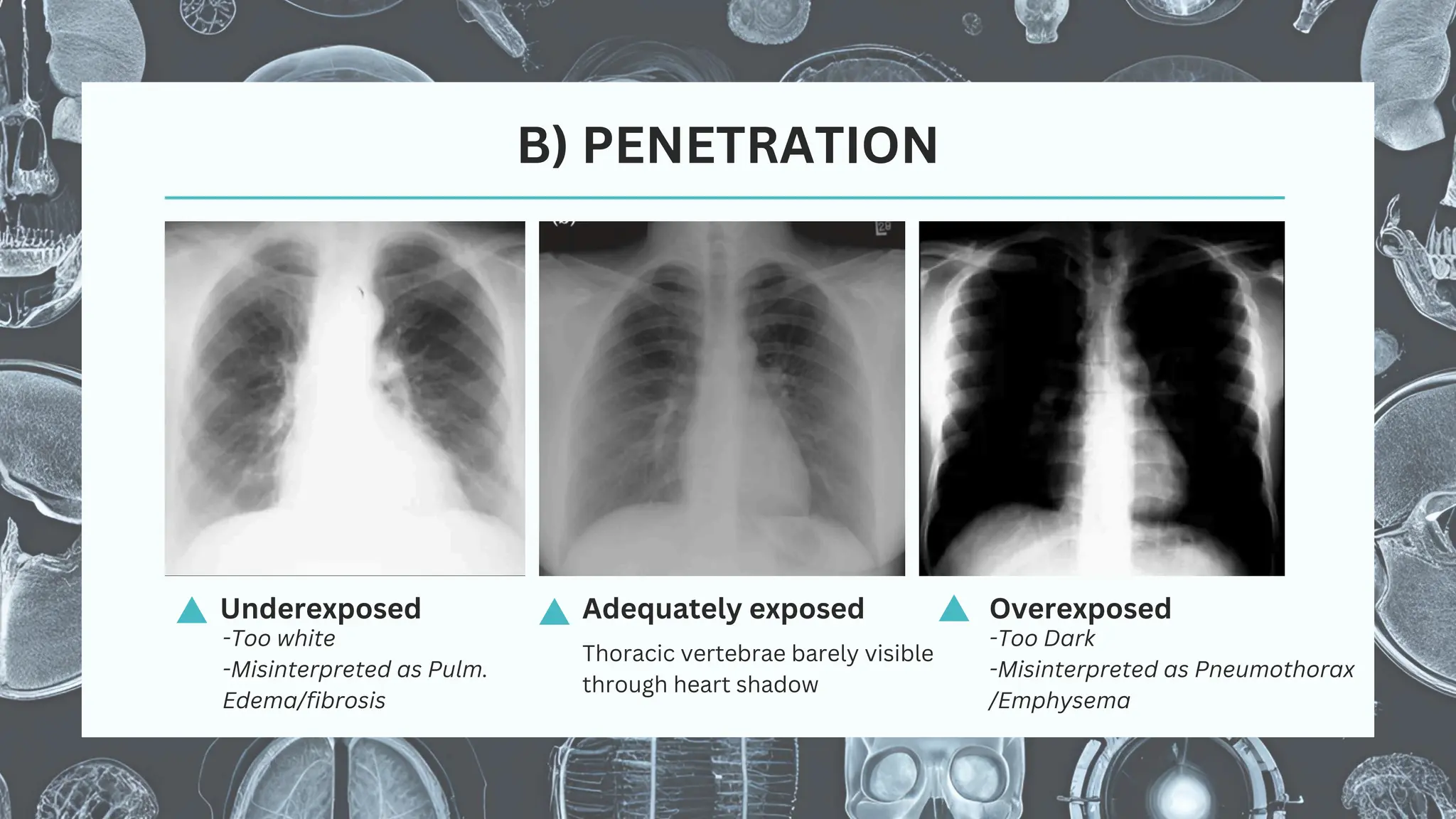 Normal chest Xray: Fundamentals and Basic Interpretation (By Dr ...