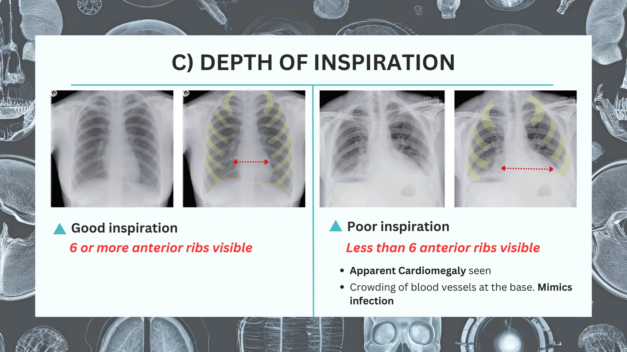 Normal chest Xray: Fundamentals and Basic Interpretation (By Dr ...