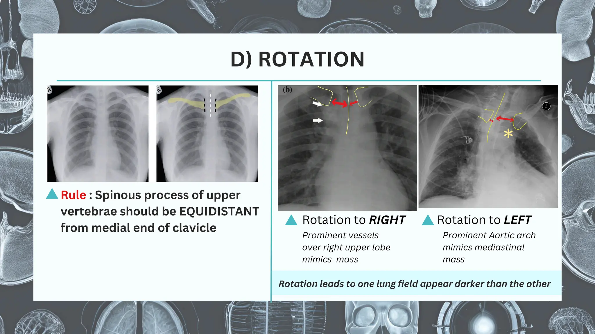 Normal chest Xray: Fundamentals and Basic Interpretation (By Dr ...
