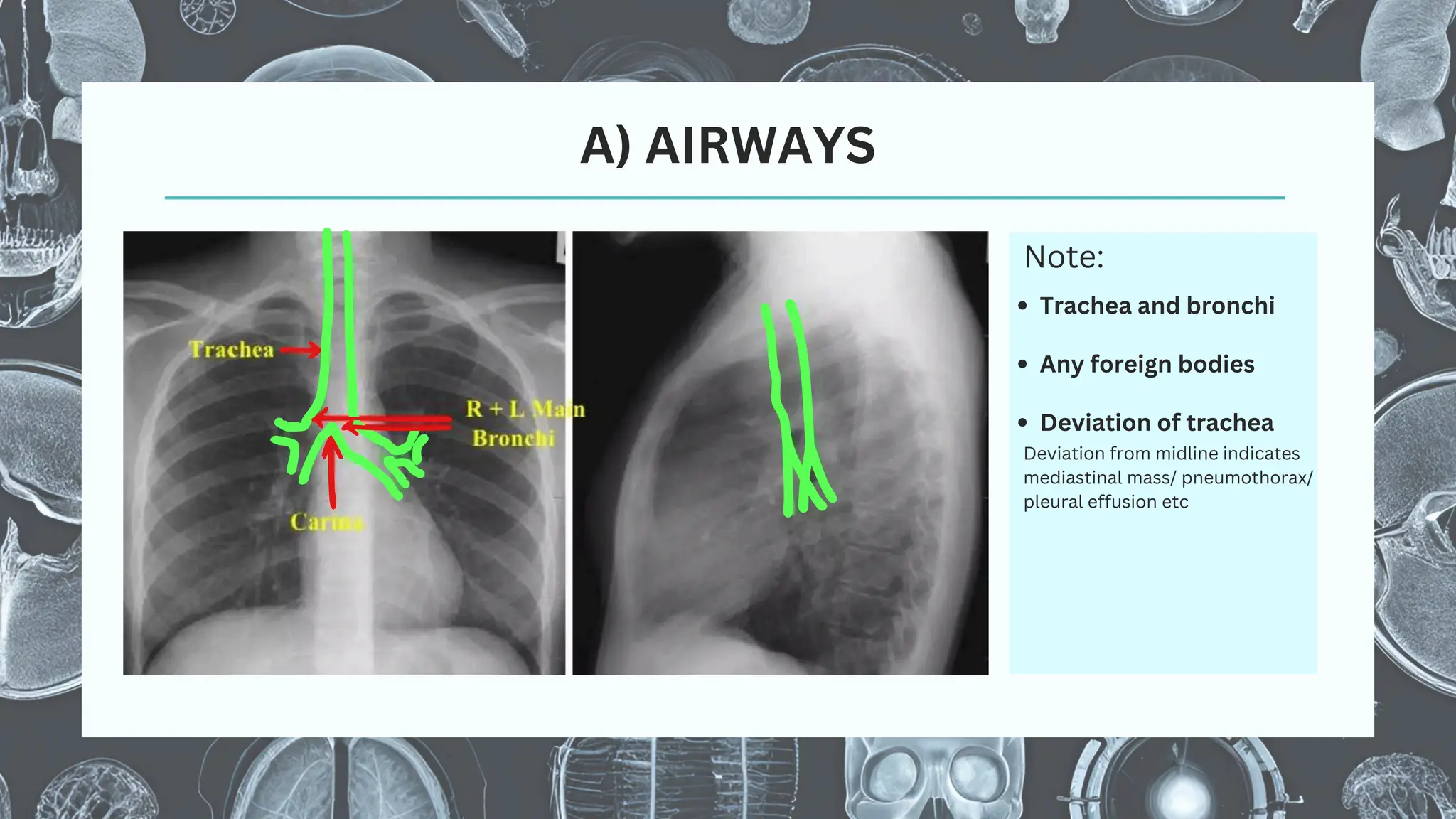 Normal chest Xray: Fundamentals and Basic Interpretation (By Dr ...