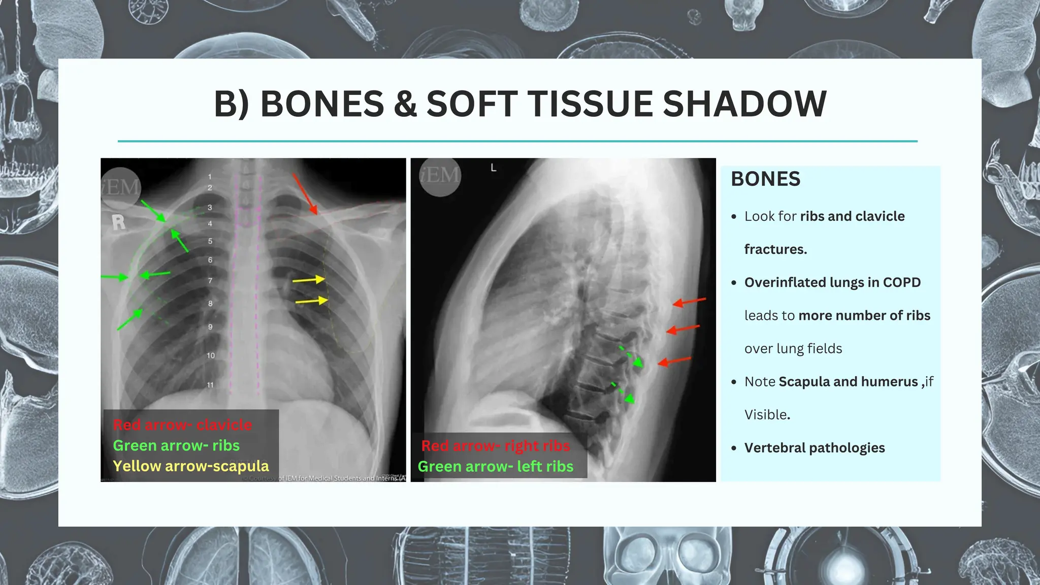 Normal chest Xray: Fundamentals and Basic Interpretation (By Dr ...