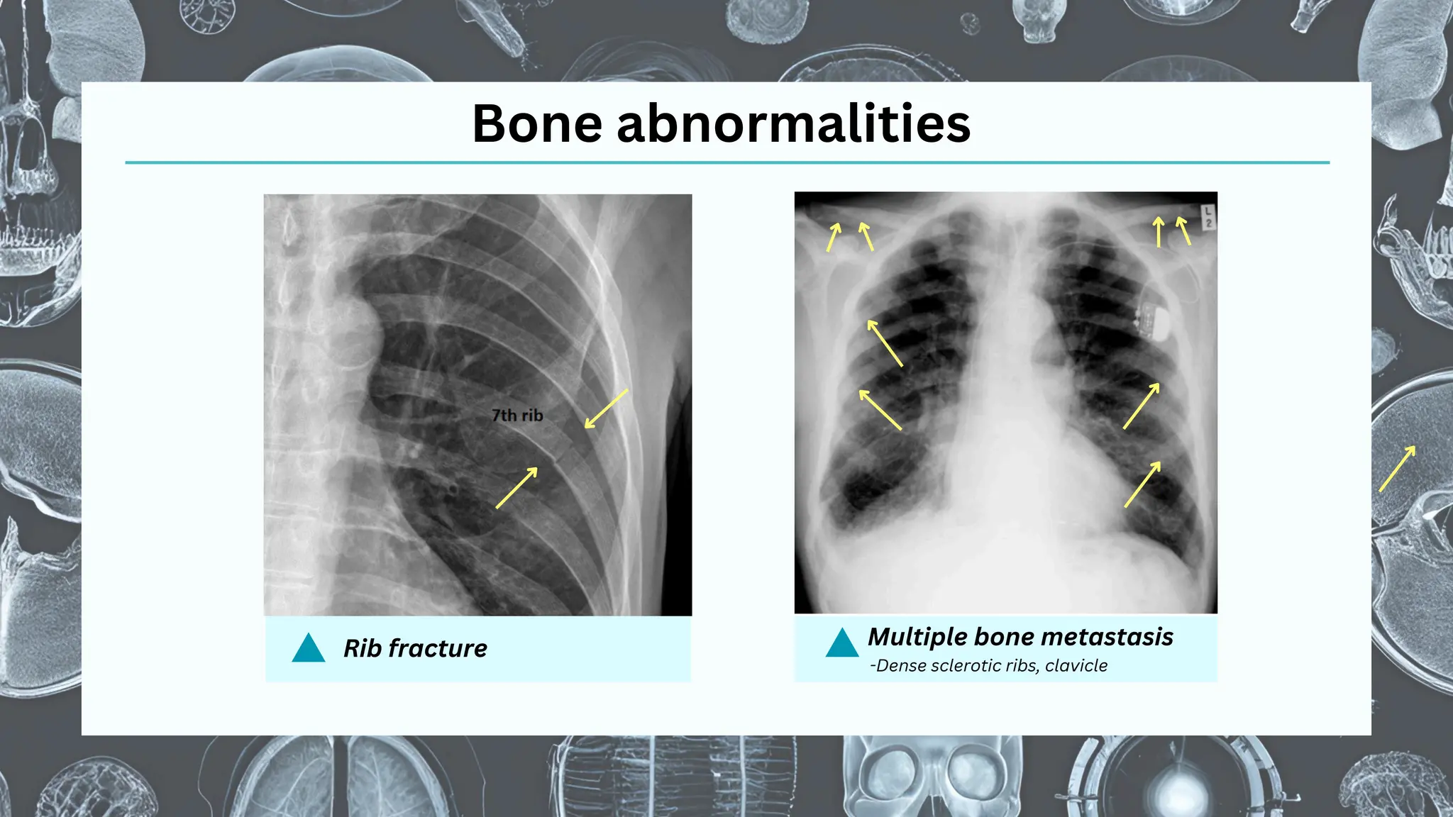 Normal chest Xray: Fundamentals and Basic Interpretation (By Dr ...
