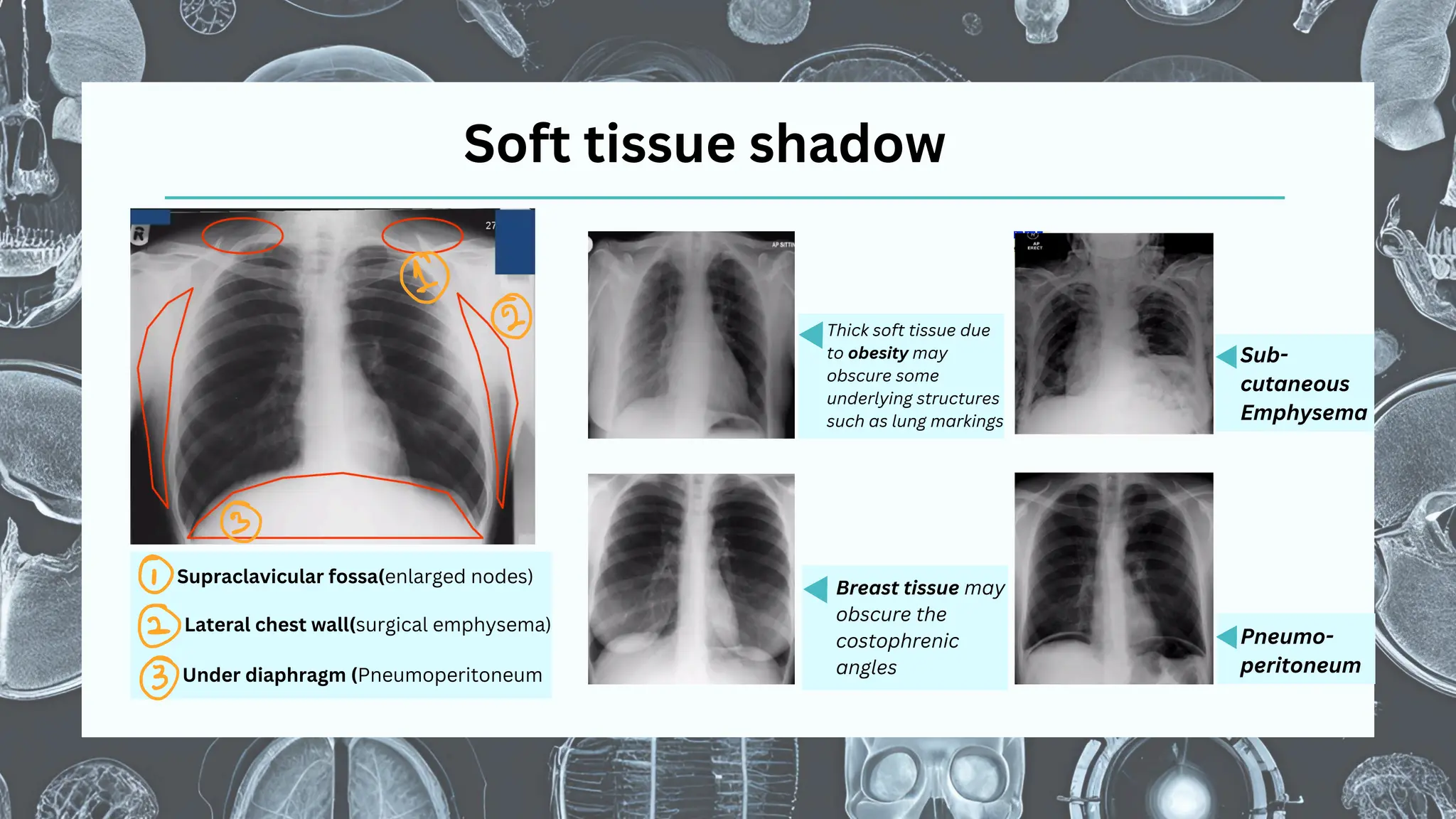Normal chest Xray: Fundamentals and Basic Interpretation (By Dr ...