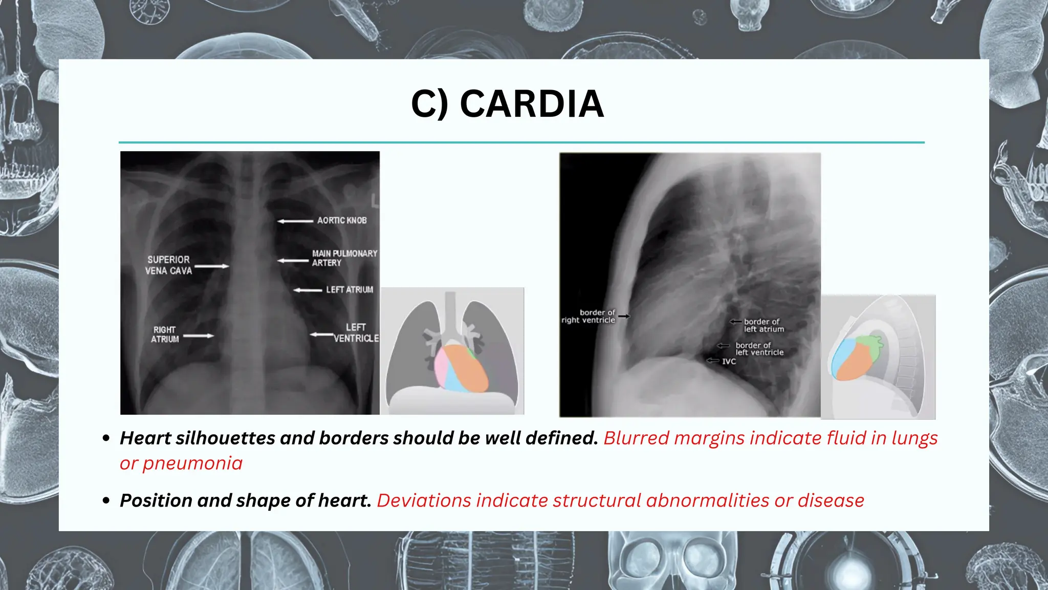 Normal chest Xray: Fundamentals and Basic Interpretation (By Dr ...