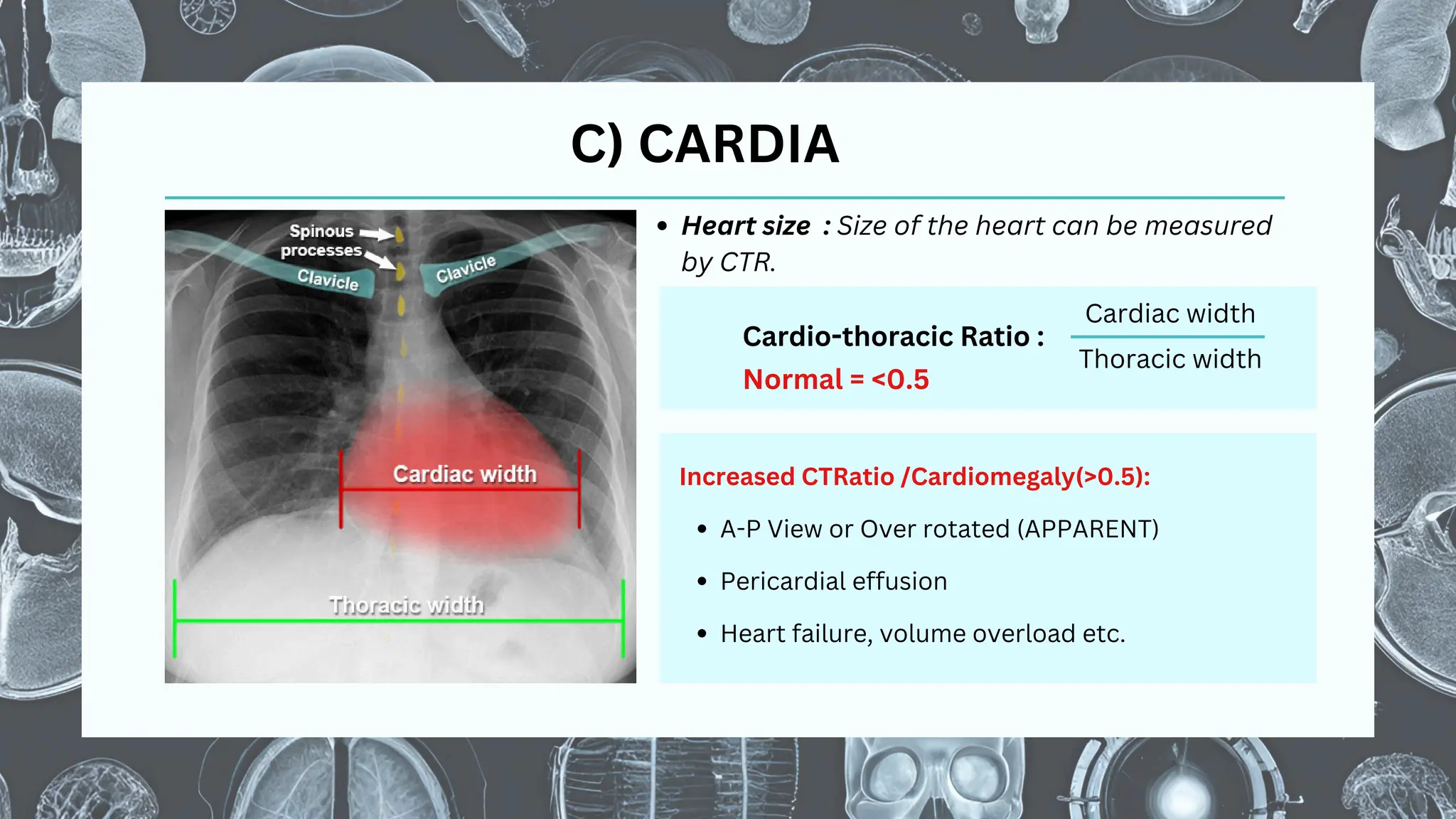 Normal chest Xray: Fundamentals and Basic Interpretation (By Dr ...