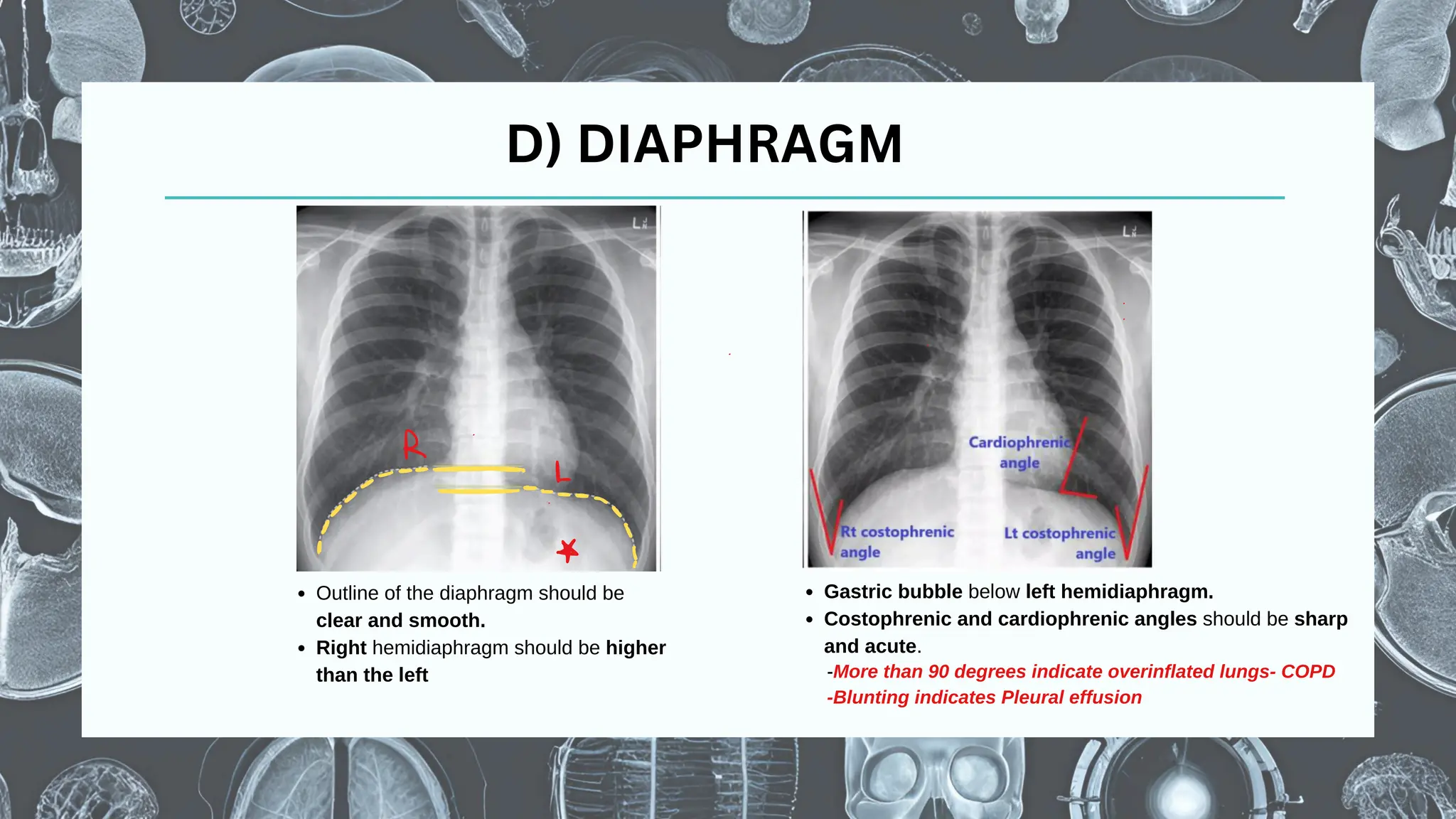 Normal chest Xray: Fundamentals and Basic Interpretation (By Dr ...