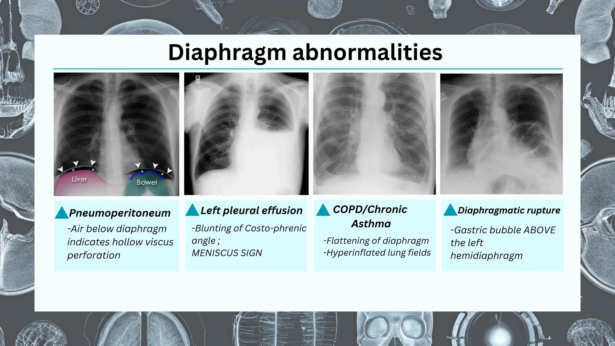 Normal chest Xray: Fundamentals and Basic Interpretation (By Dr ...