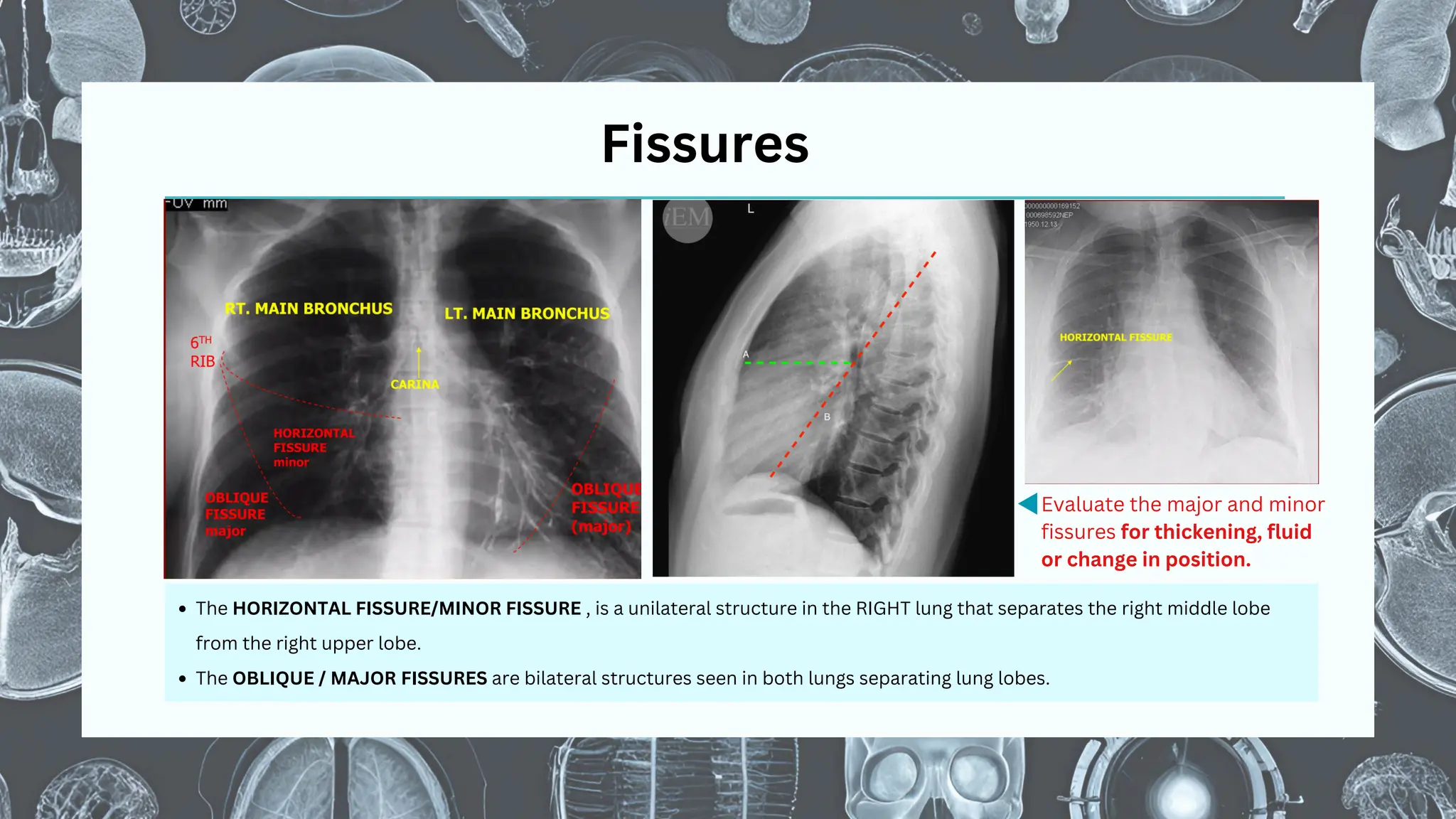 Normal chest Xray: Fundamentals and Basic Interpretation (By Dr ...