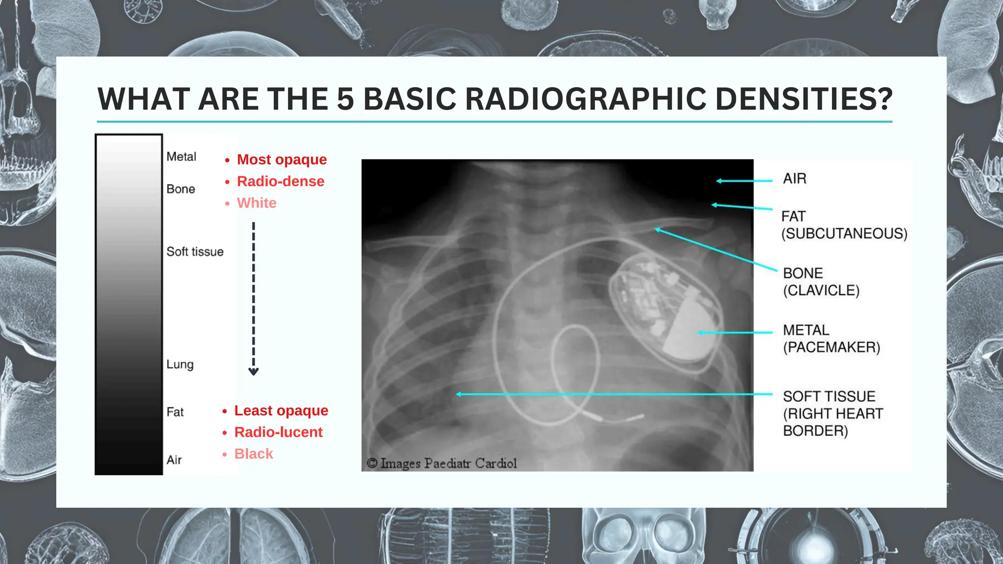 Normal chest Xray: Fundamentals and Basic Interpretation (By Dr ...