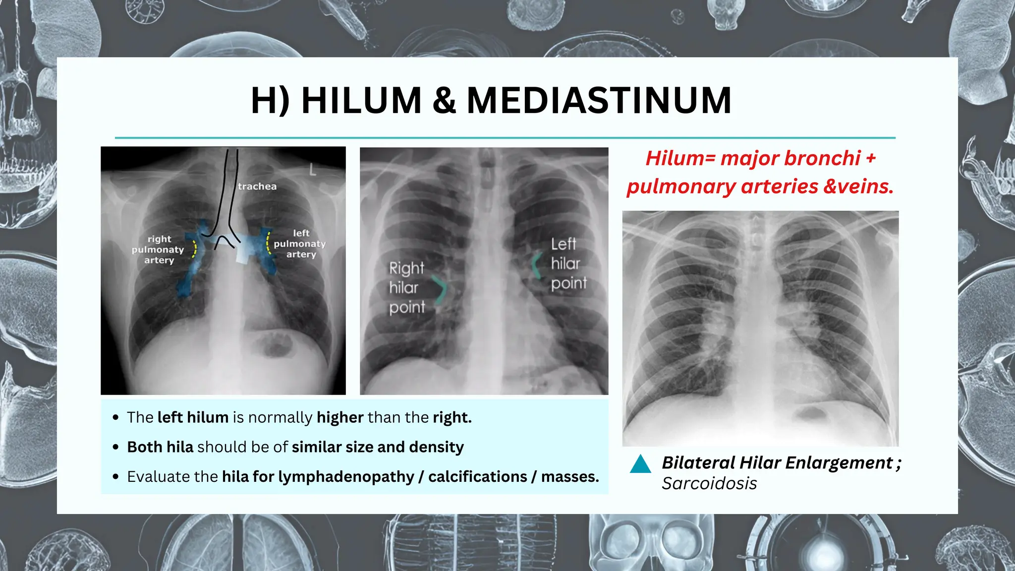 Normal chest Xray: Fundamentals and Basic Interpretation (By Dr ...