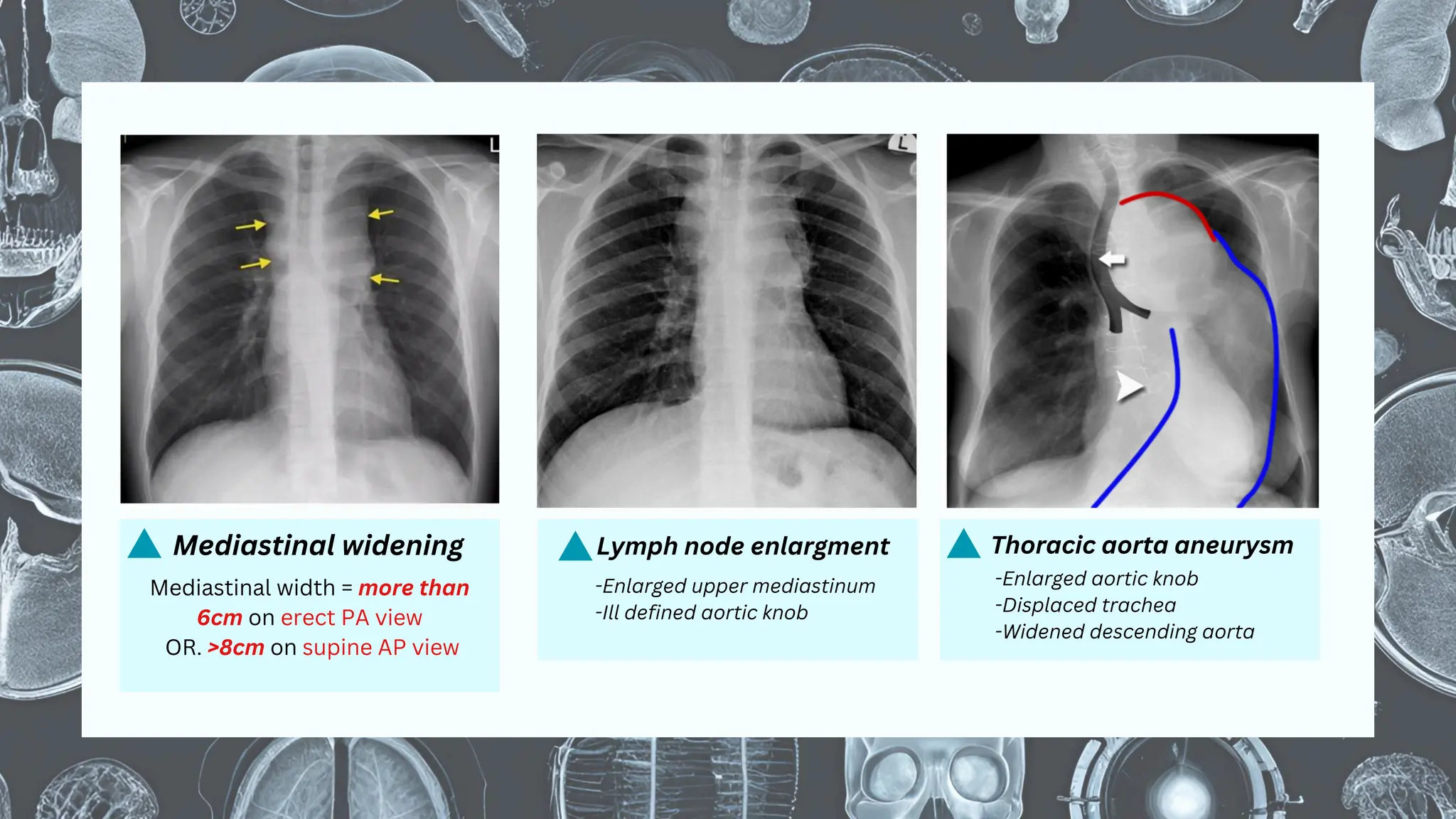 Normal chest Xray: Fundamentals and Basic Interpretation (By Dr ...