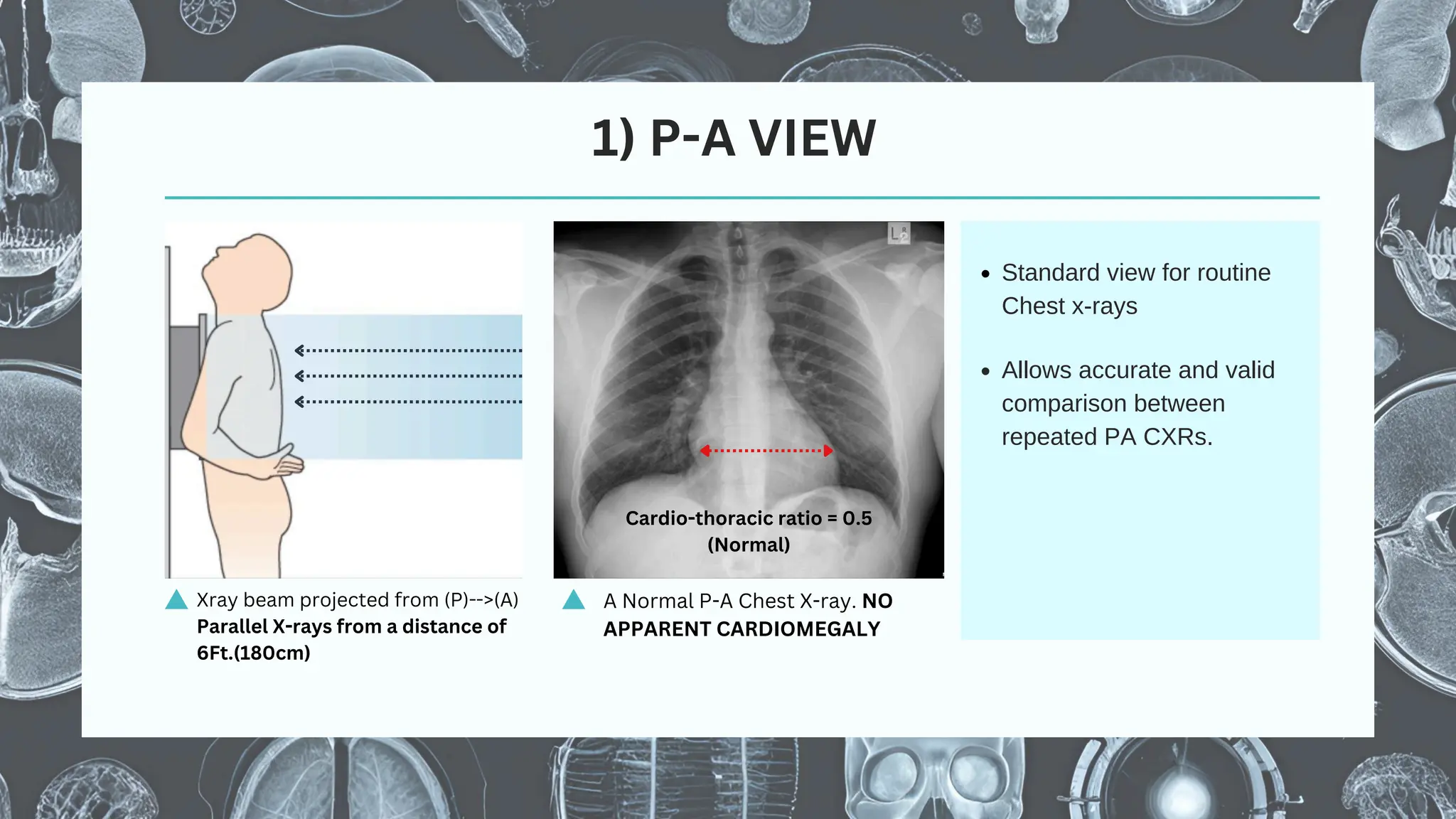 Normal chest Xray: Fundamentals and Basic Interpretation (By Dr ...