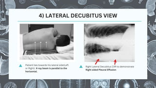 Normal chest Xray: Fundamentals and Basic Interpretation (By Dr ...