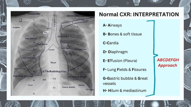 Normal chest Xray: Fundamentals and Basic Interpretation (By Dr ...