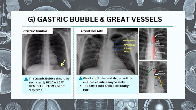 Normal chest Xray: Fundamentals and Basic Interpretation (By Dr ...