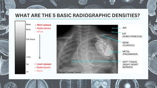 Normal chest Xray: Fundamentals and Basic Interpretation (By Dr ...
