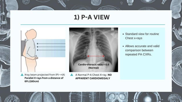 Normal chest Xray: Fundamentals and Basic Interpretation (By Dr ...
