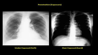 Normal chest x ray and collapse | PPTX