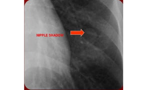 Normal chest x ray and collapse | PPTX