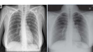 Normal chest x ray and collapse | PPTX