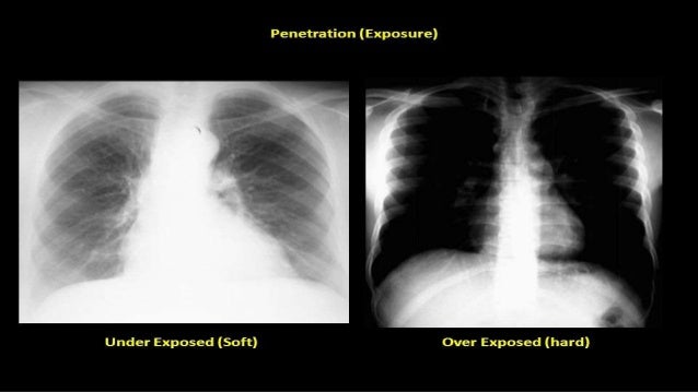Normal chest x ray and collapse