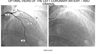 NORMAL CORONARY ANATOMY AND ANGIOGRAPHIC VIEWS SOURCE.pptx