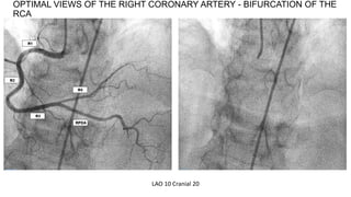 NORMAL CORONARY ANATOMY AND ANGIOGRAPHIC VIEWS SOURCE.pptx