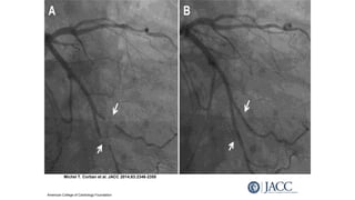 NORMAL CORONARY ANATOMY AND ANGIOGRAPHIC VIEWS SOURCE.pptx